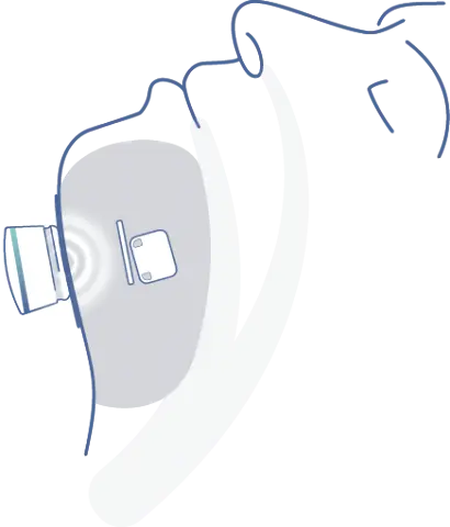 Nyxoah Provides Update on FDA Approvable Letter for Genio System - BioWin